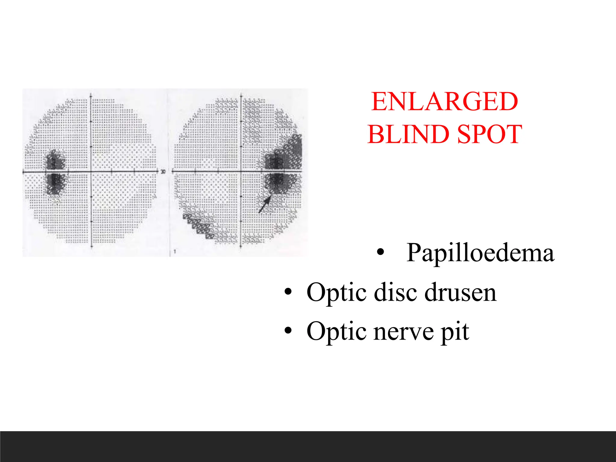 visual fields in neuro ophthalmology-part 1 | PPTX