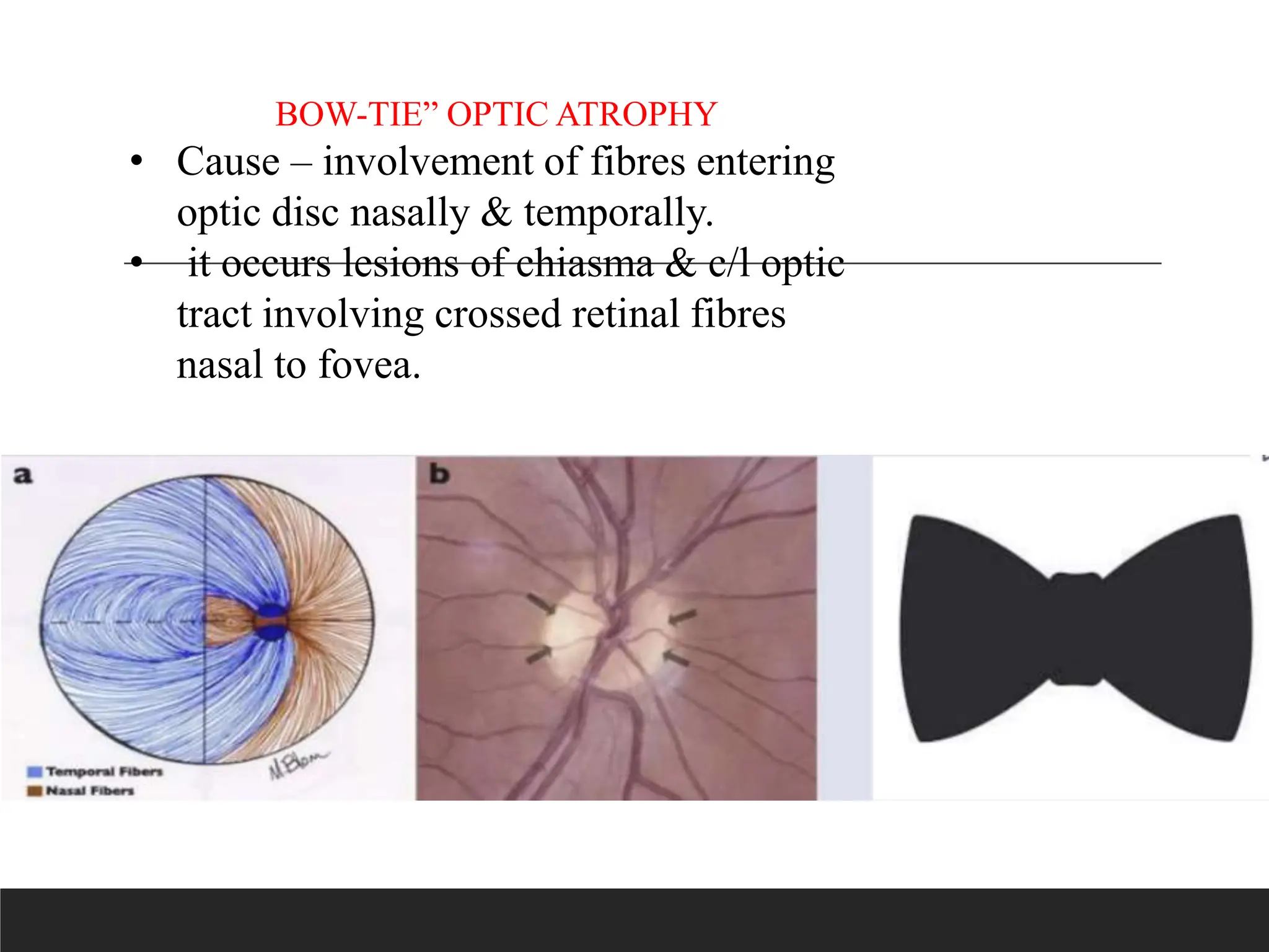 visual fields in neuro ophthalmology-part 1 | PPTX
