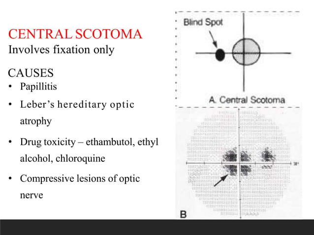 visual fields in neuro ophthalmology-part 1 | PPT