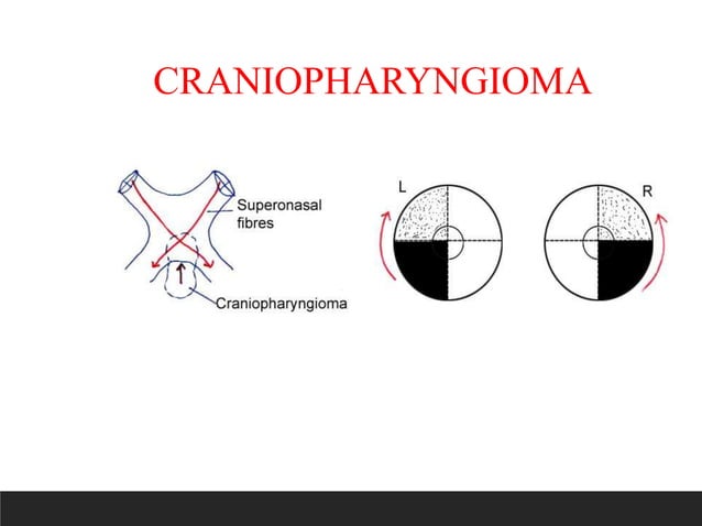 visual fields in neuro ophthalmology-part 1 | PPT