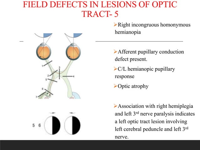 visual fields in neuro ophthalmology-part 1 | PPT
