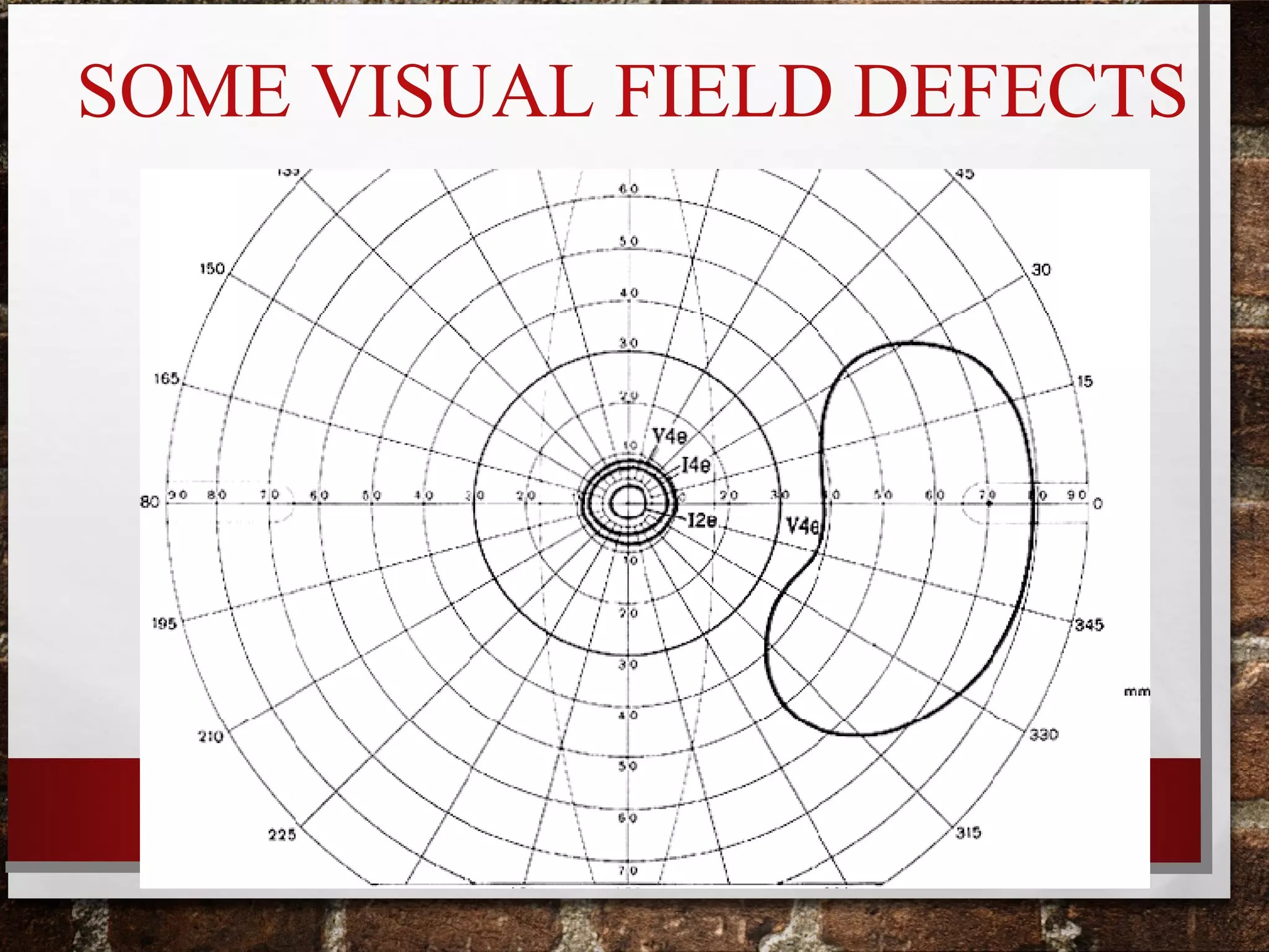 Visual field testing and interpretation | PPT | Eye and Vision ...