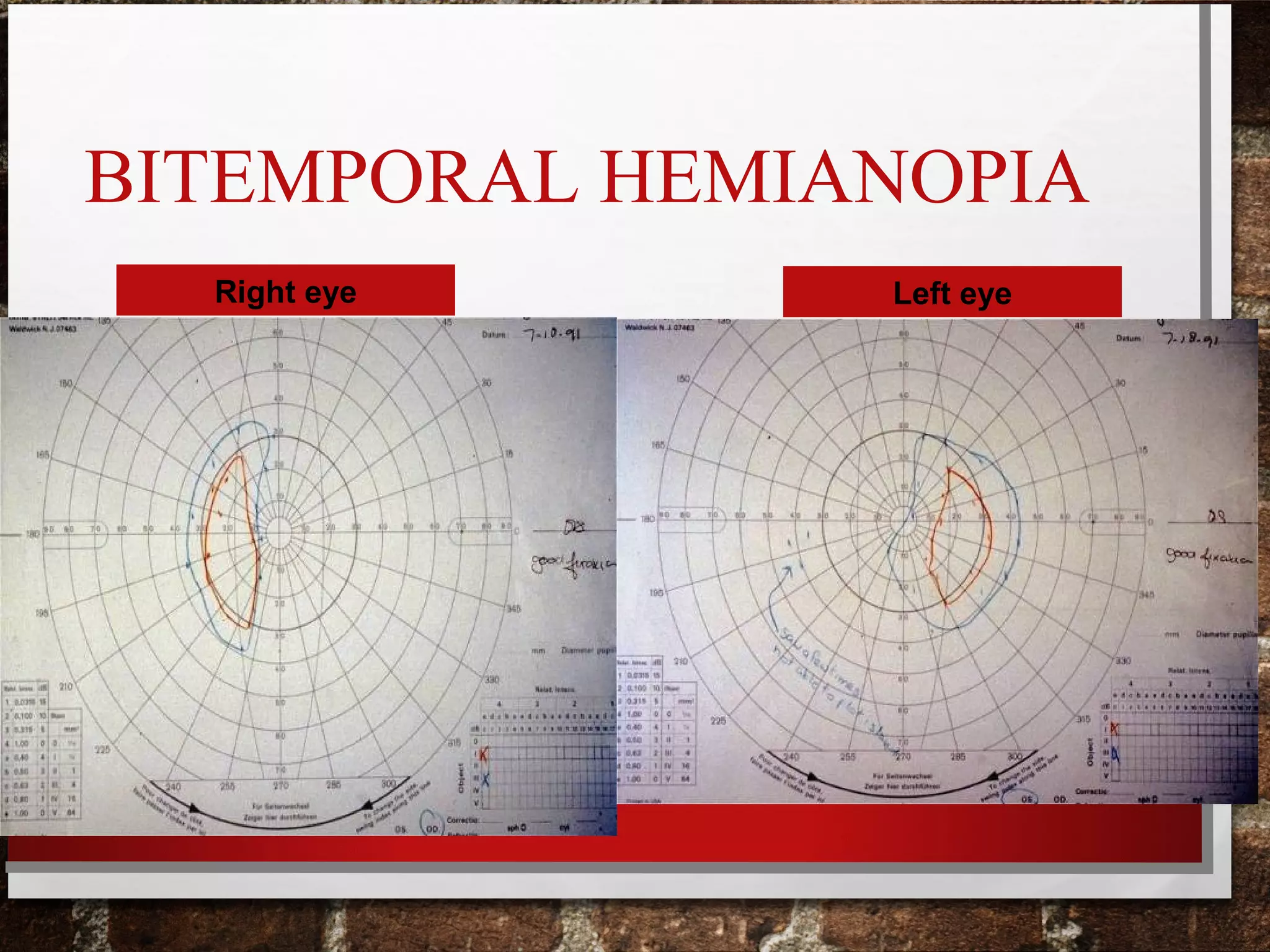 Visual field testing and interpretation | PPT
