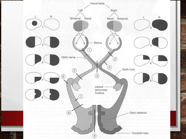 Visual field testing and interpretation | PPT | Eye and Vision ...