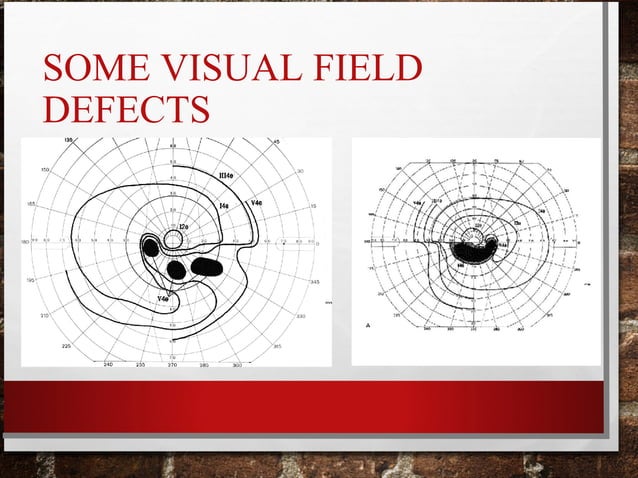 Visual field testing and interpretation | PPT | Eye and Vision ...