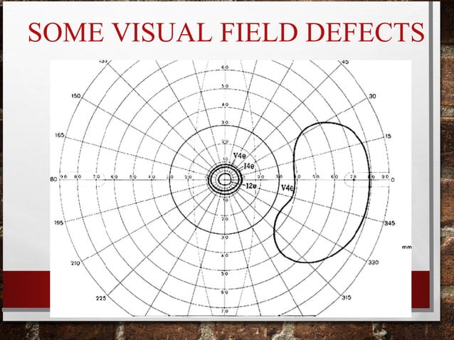 Visual field testing and interpretation | PPT | Eye and Vision ...
