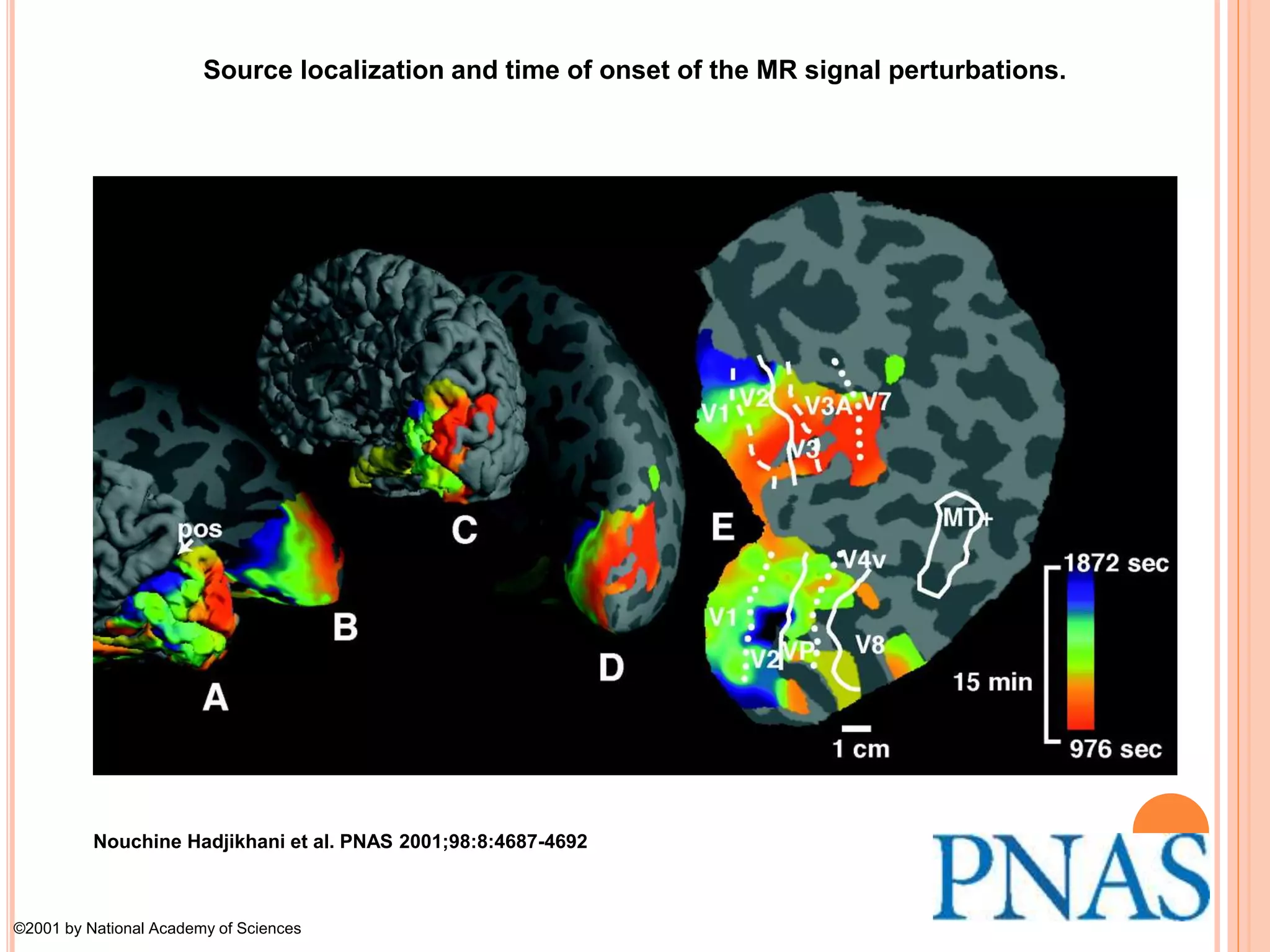 Visual hallucinations: Differential diagnosis & treatment | PPT