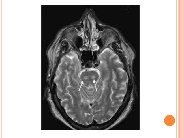 Visual hallucinations: Differential diagnosis & treatment | PPT