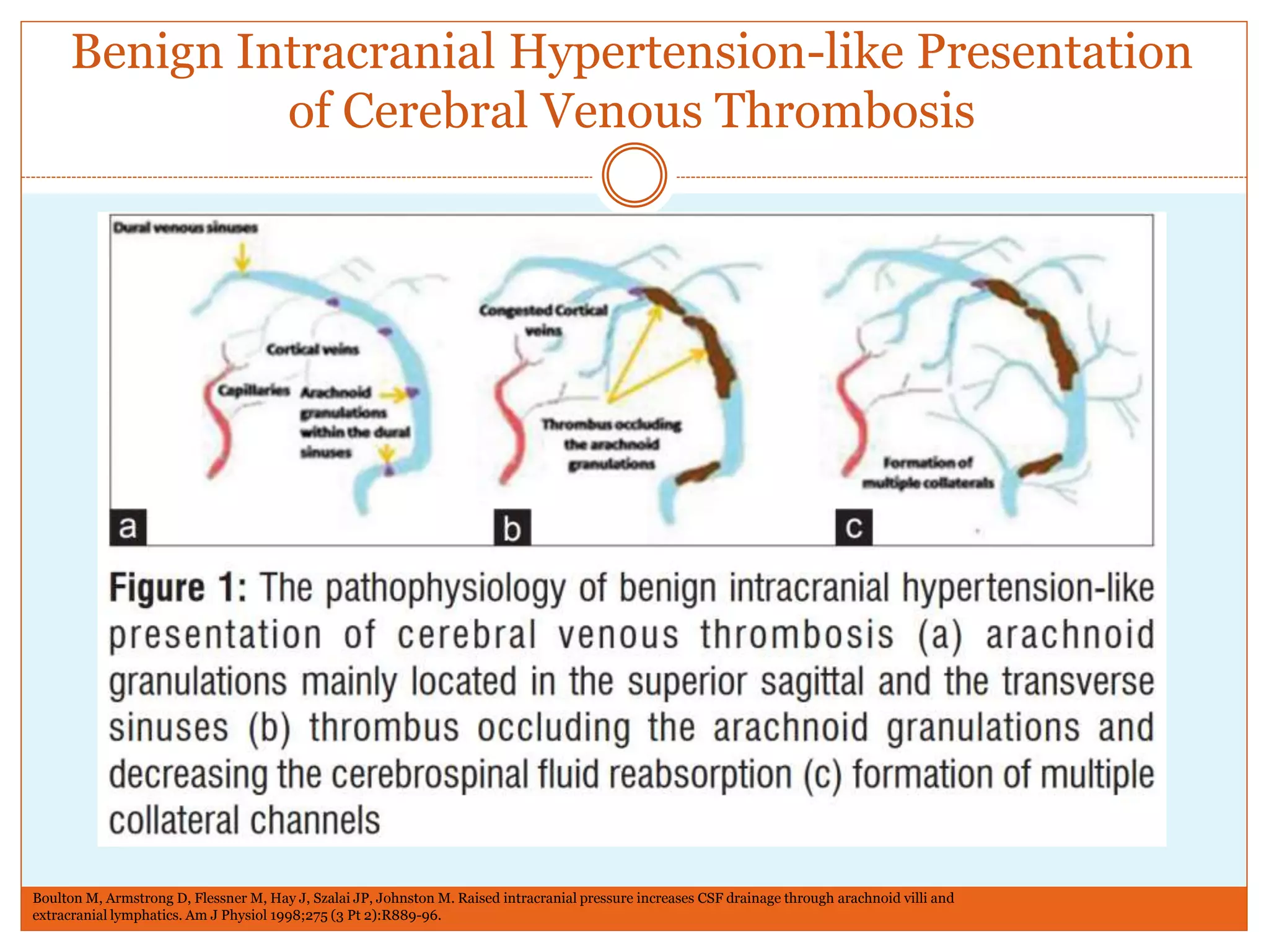 Visual Impairment in Cerebral Venous Thrombosis.pptx