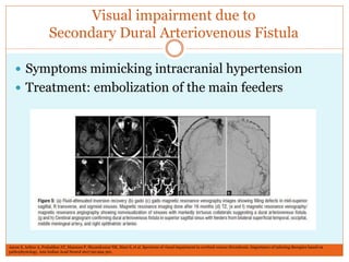 Visual Impairment in Cerebral Venous Thrombosis.pptx