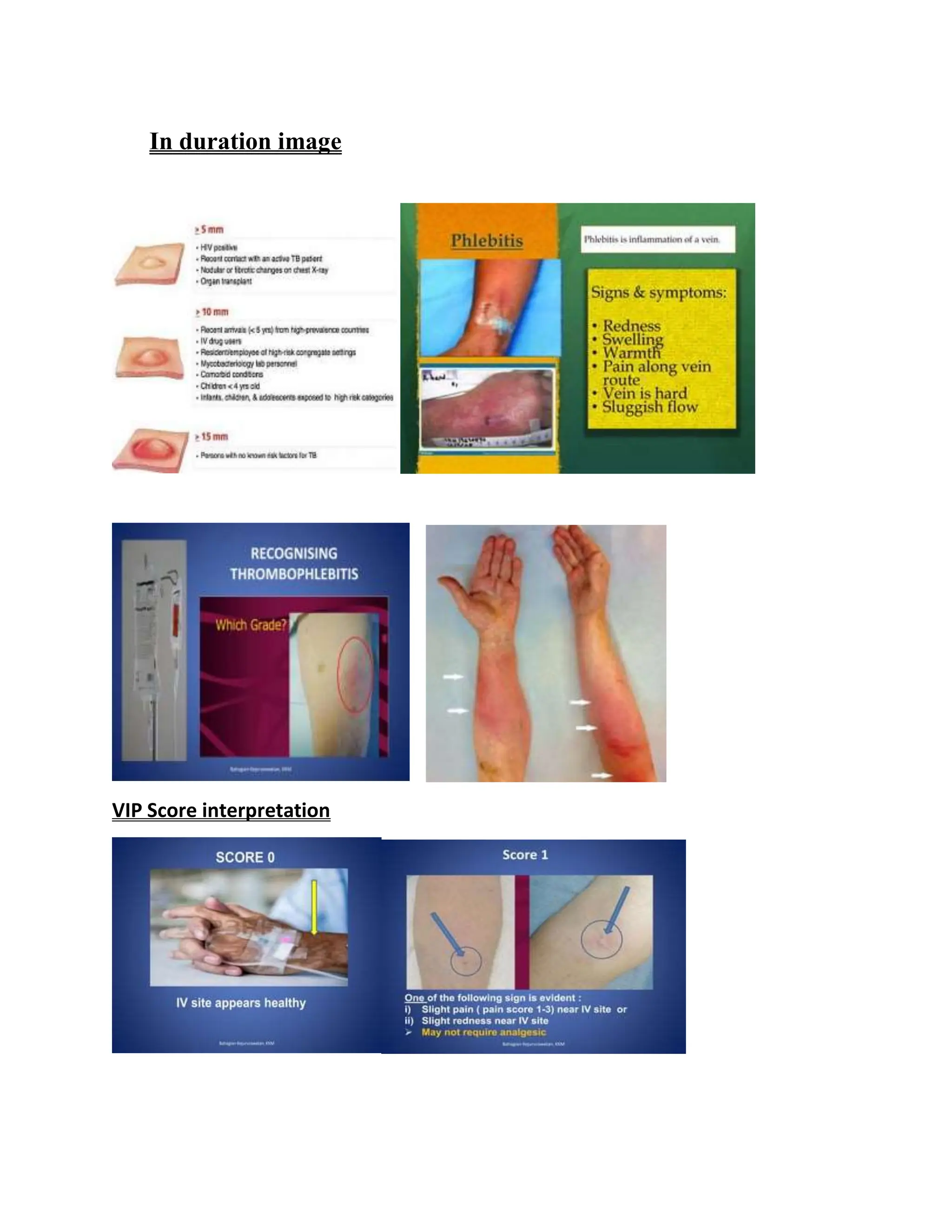 Visual infusion phelibitis checklist for direct patient care | DOCX
