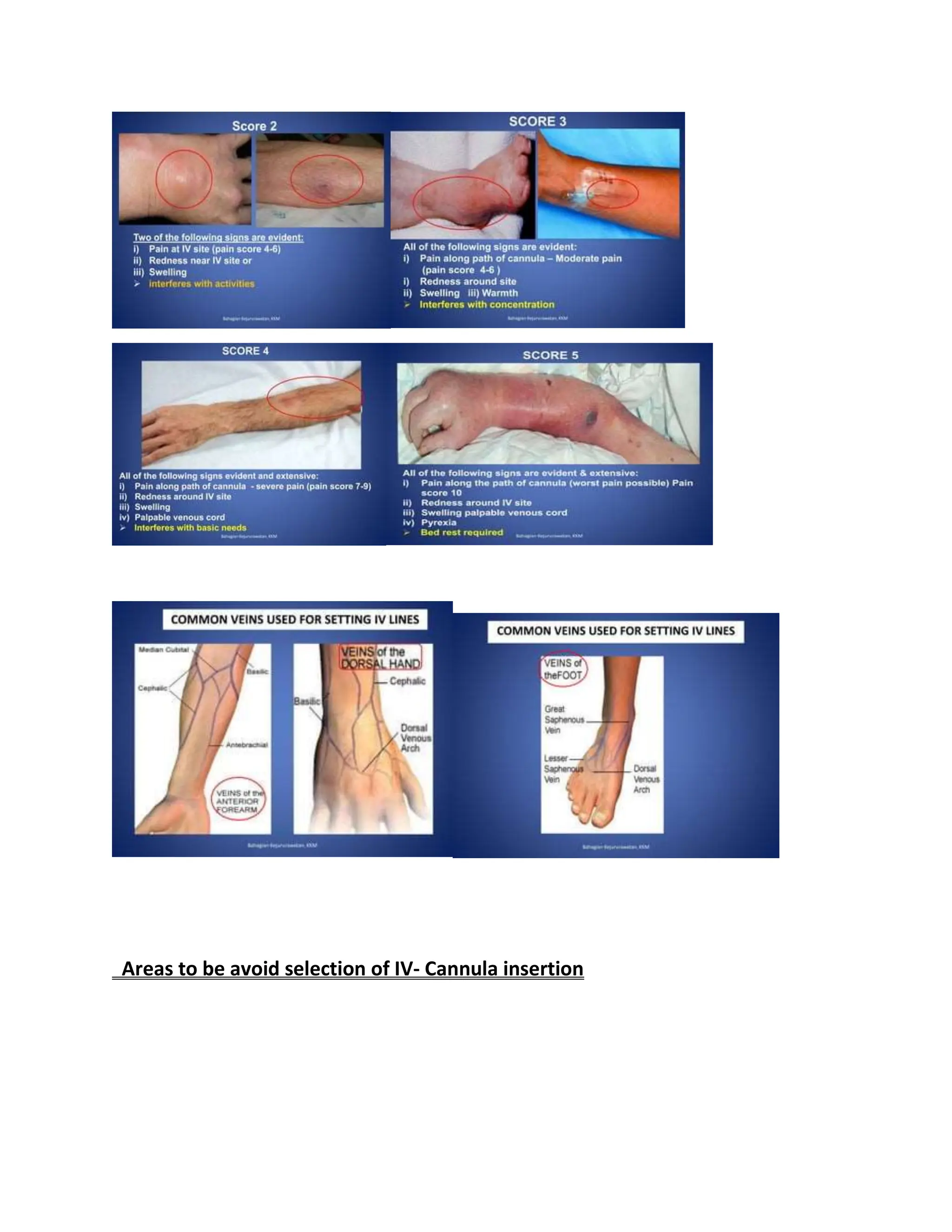Visual infusion phelibitis checklist for direct patient care | DOCX