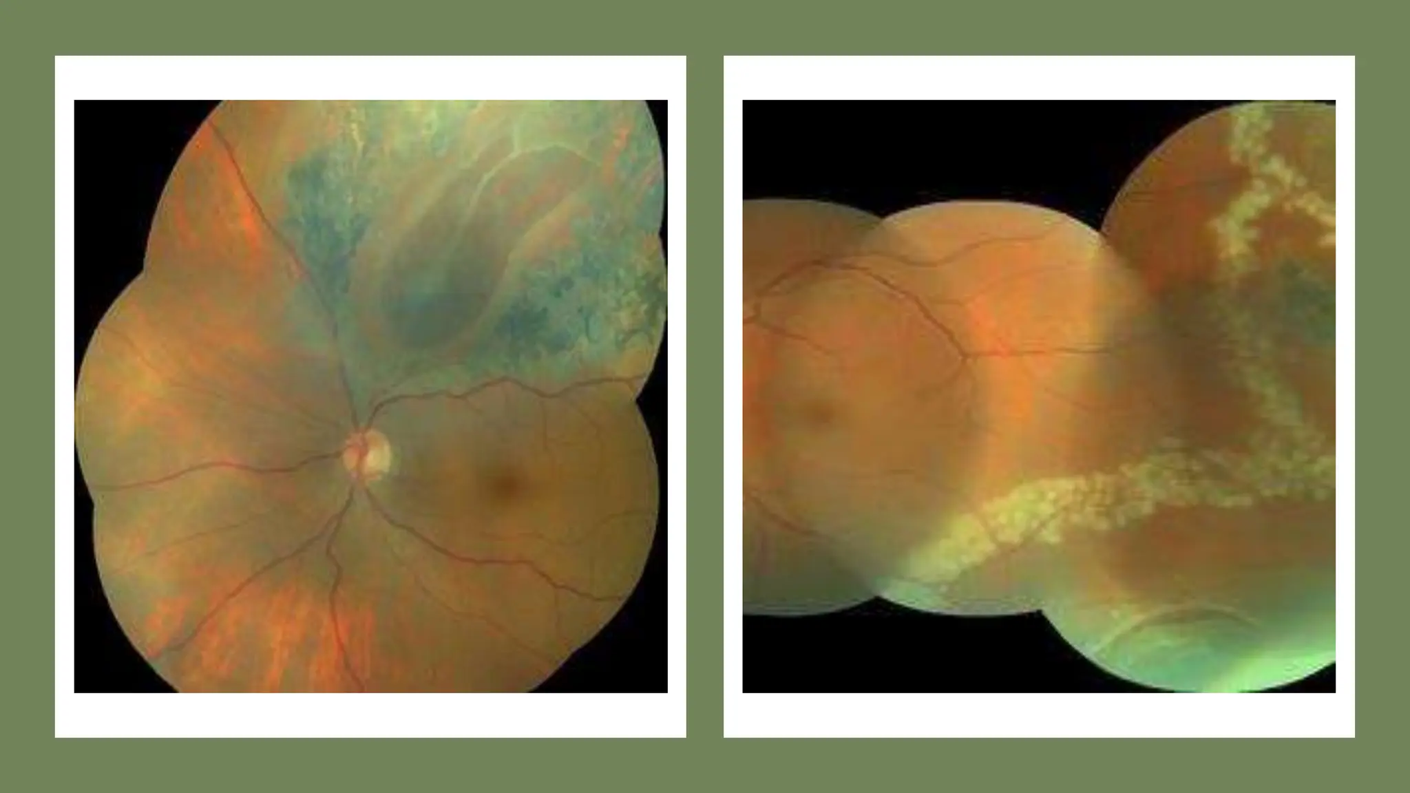 mastering visualization of posterior segment | PPT