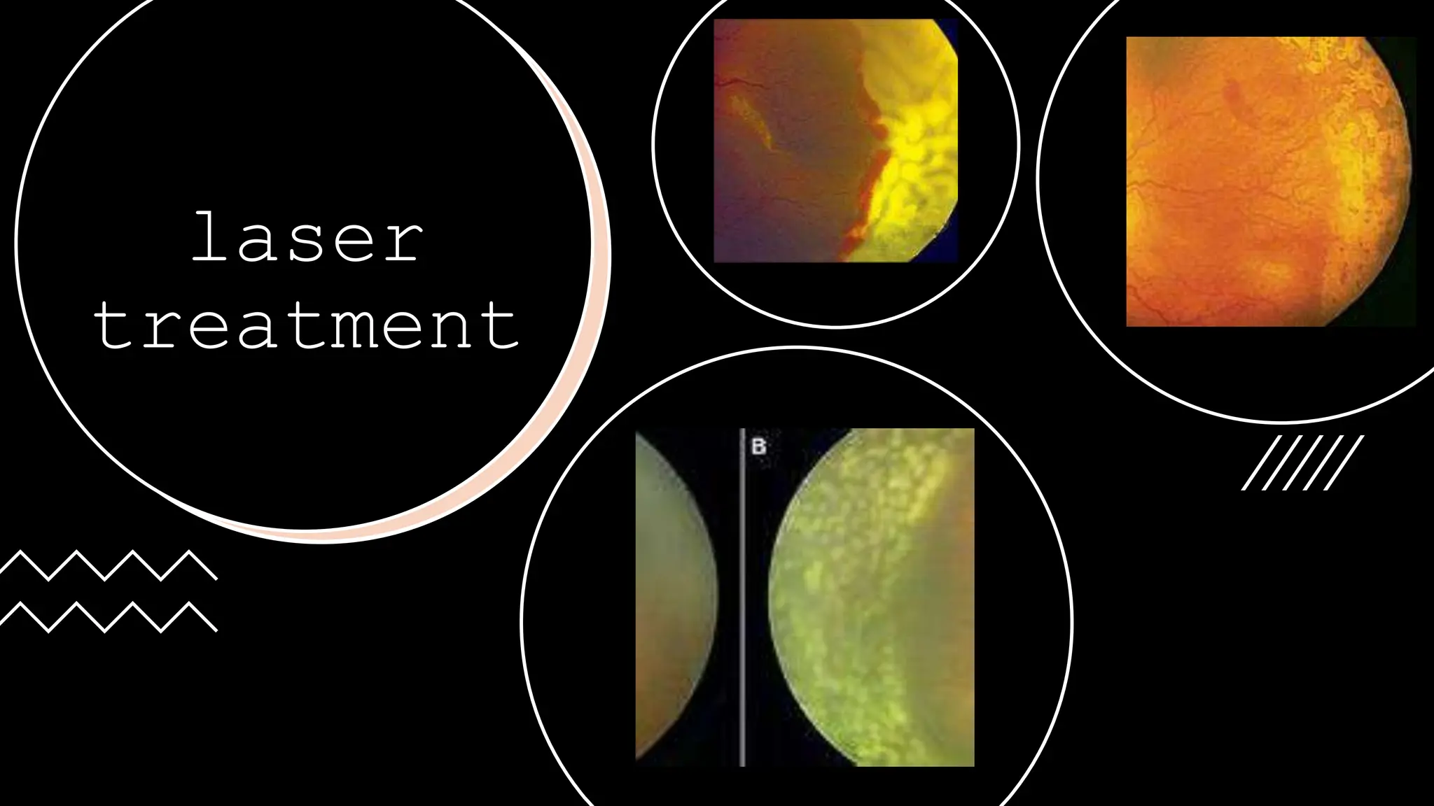 mastering visualization of posterior segment | PPT