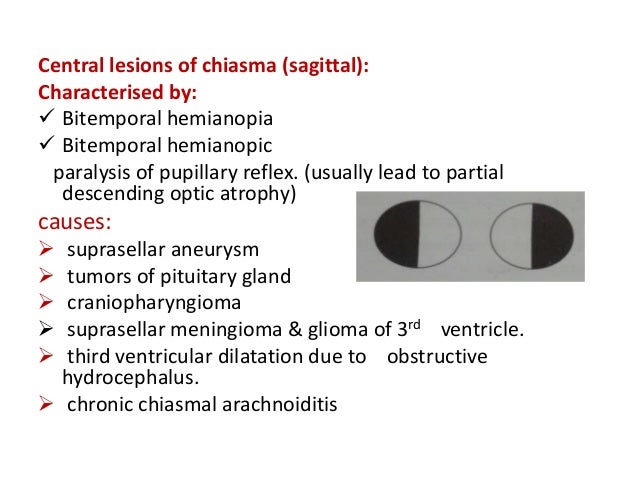Visual pathway and defects