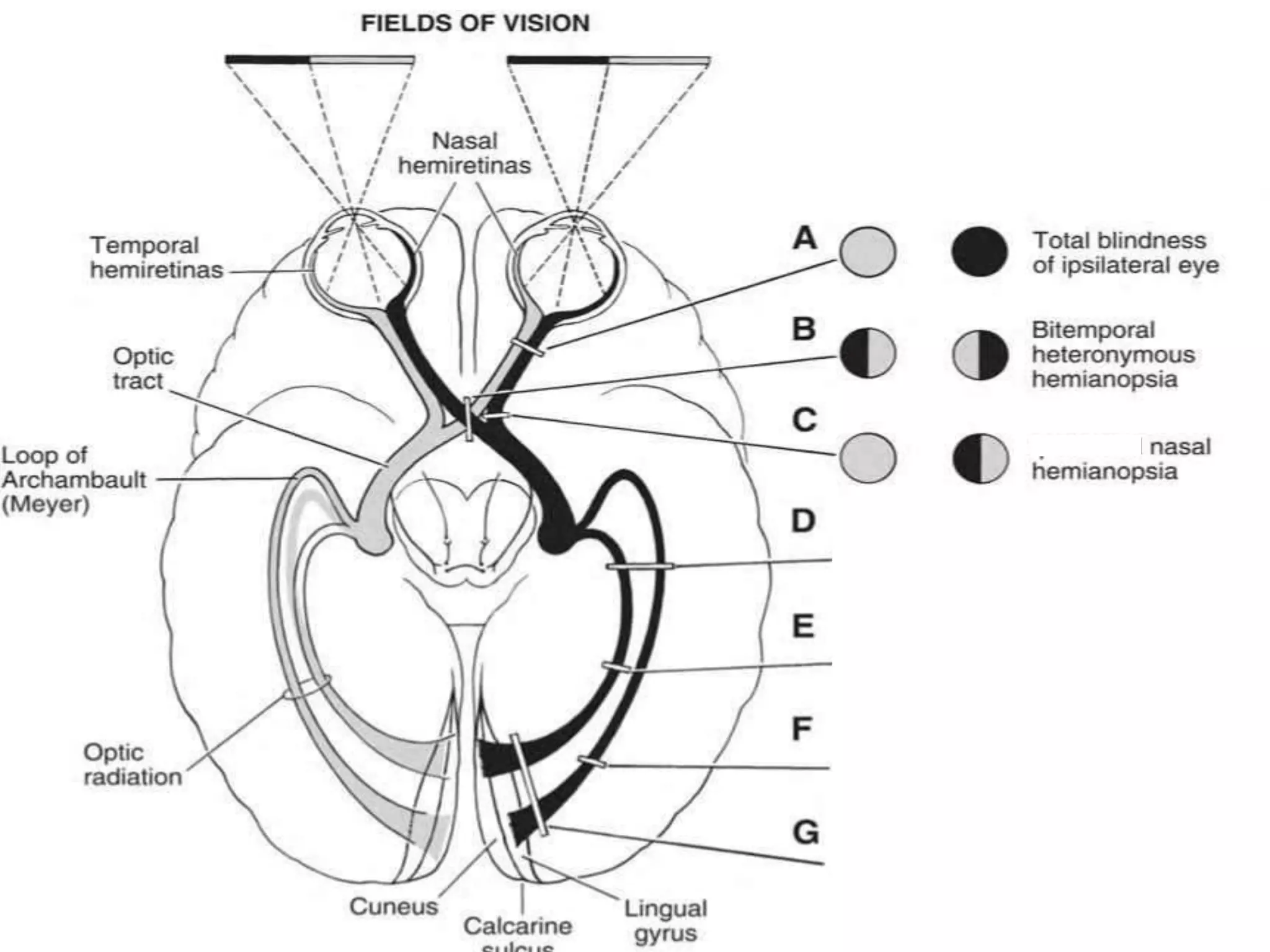 Visual pathway & lesions | PPTX