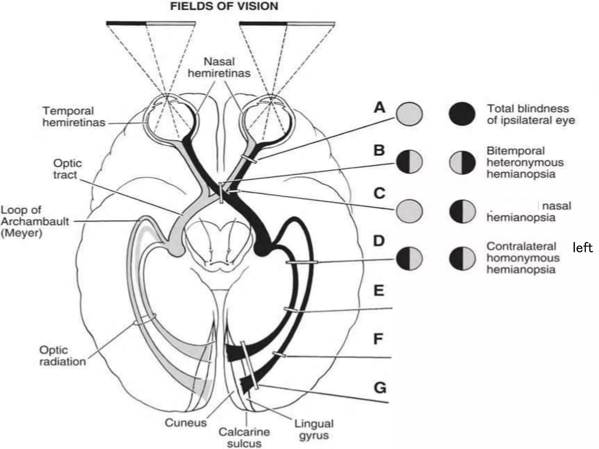 Visual pathway & lesions | PPTX