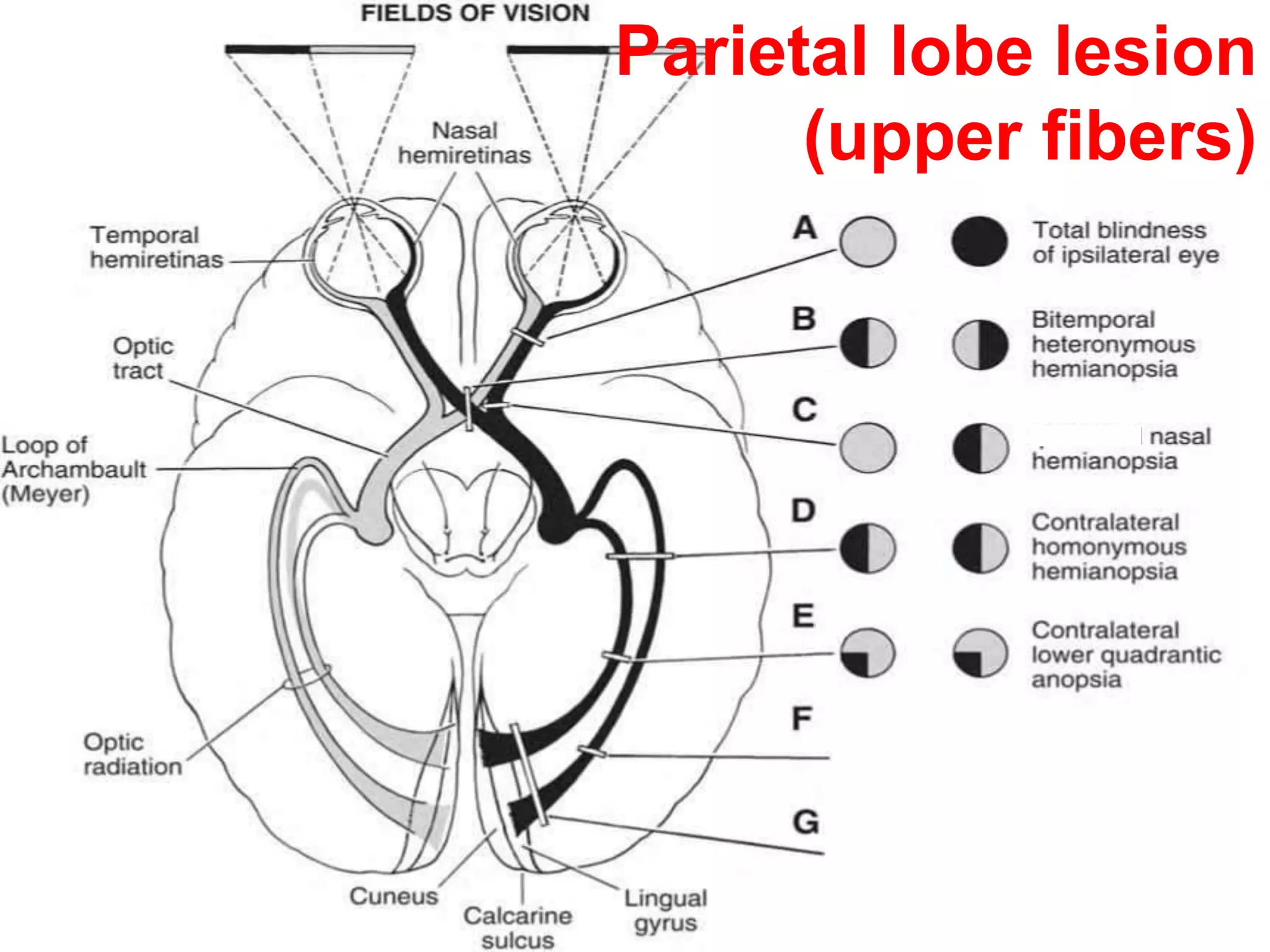 Visual pathway & lesions | PPTX