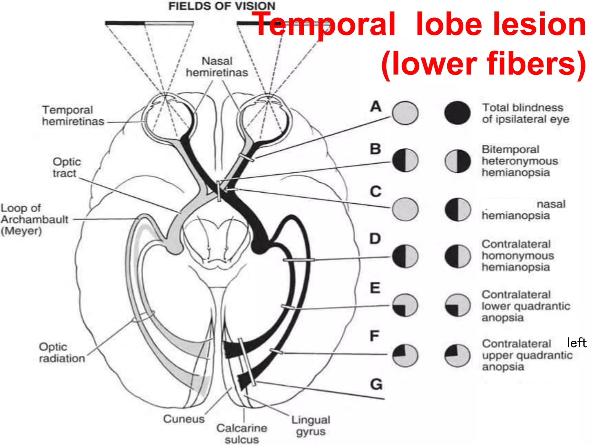 Visual pathway & lesions | PPTX