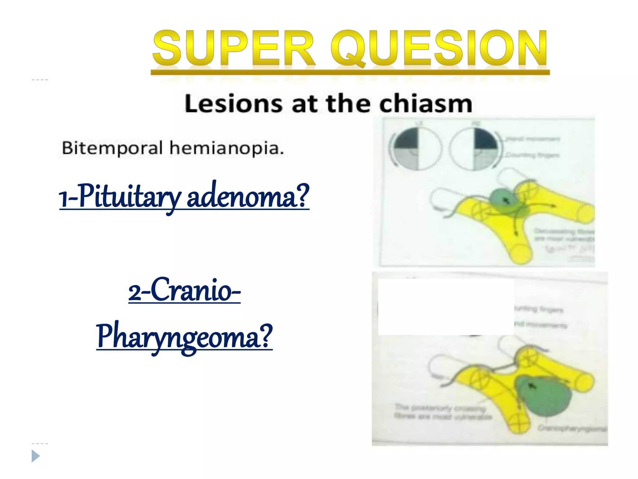 Visual pathway & lesions | PPTX