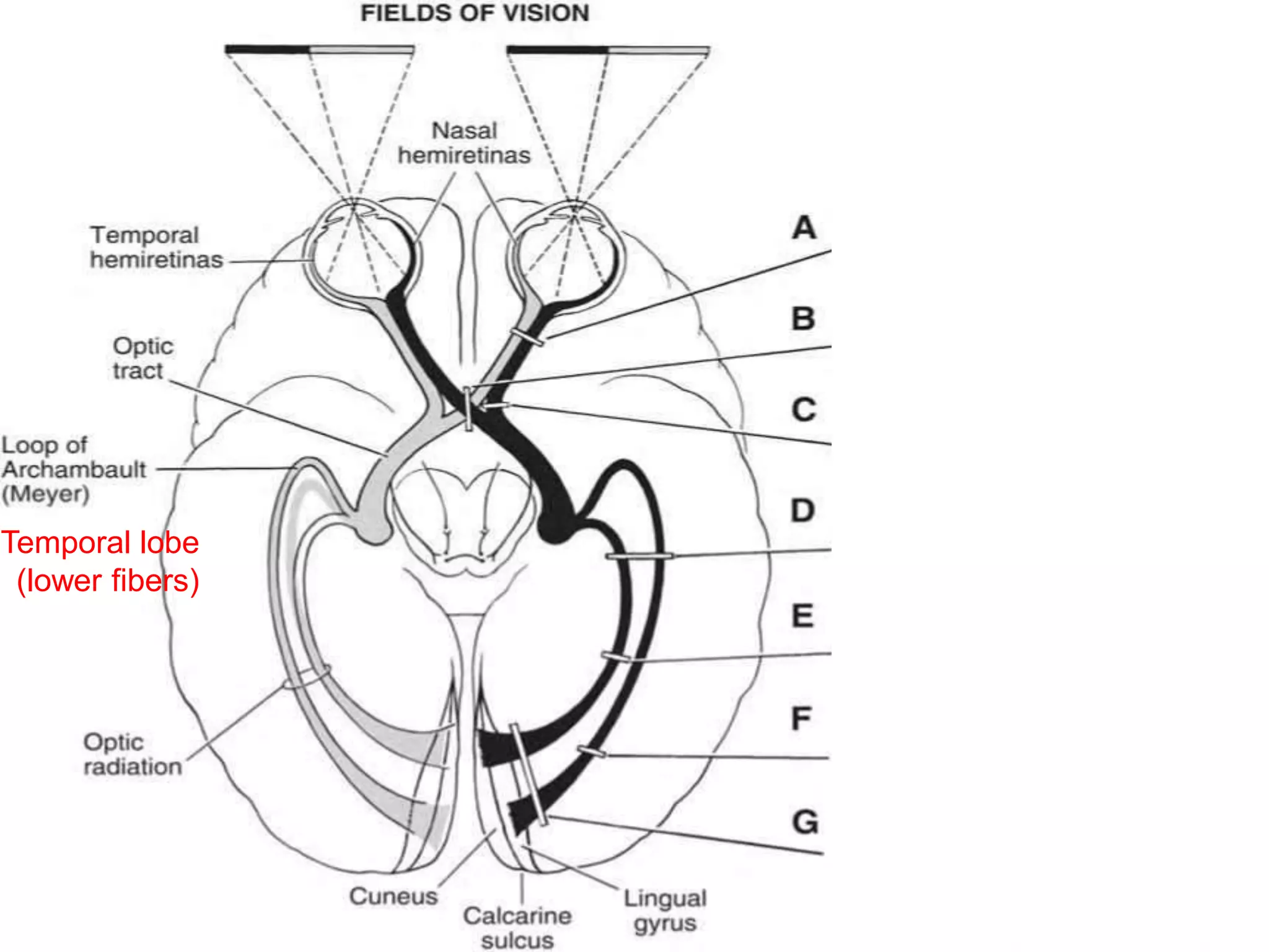 Visual pathway & lesions | PPTX