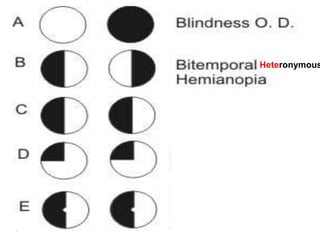 Visual pathway & lesions | PPTX