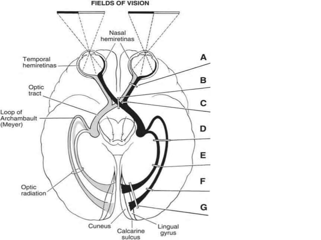 Visual pathway & lesions | PPTX