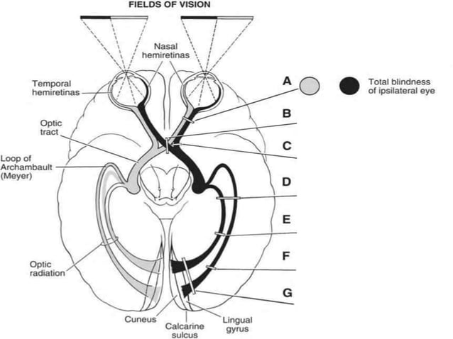 Visual pathway & lesions | PPTX