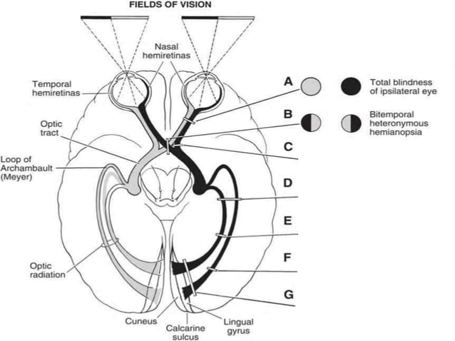 Visual pathway & lesions | PPTX