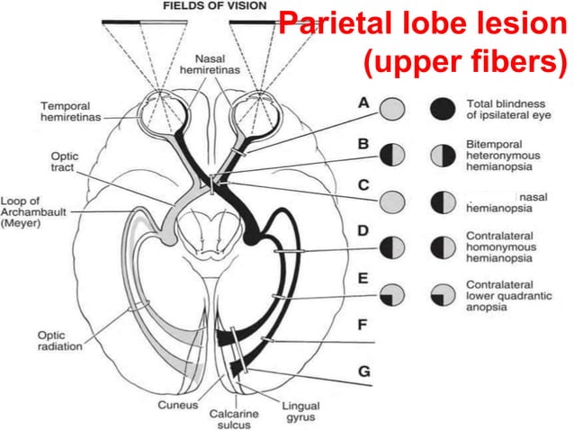Visual pathway & lesions | PPTX