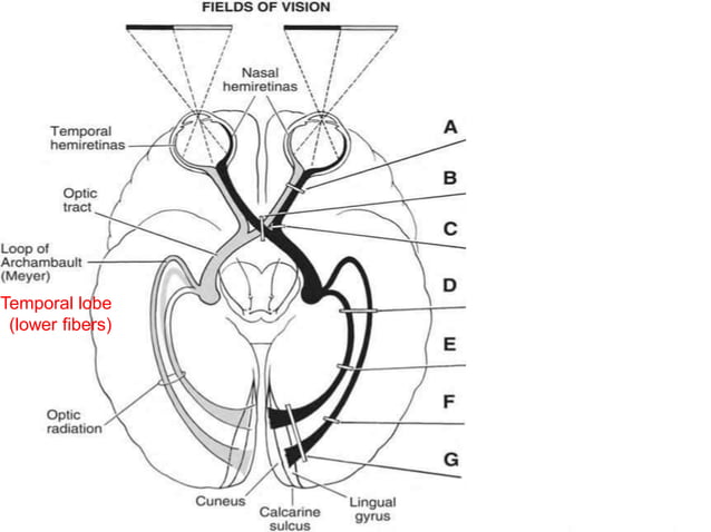 Visual pathway & lesions | PPTX