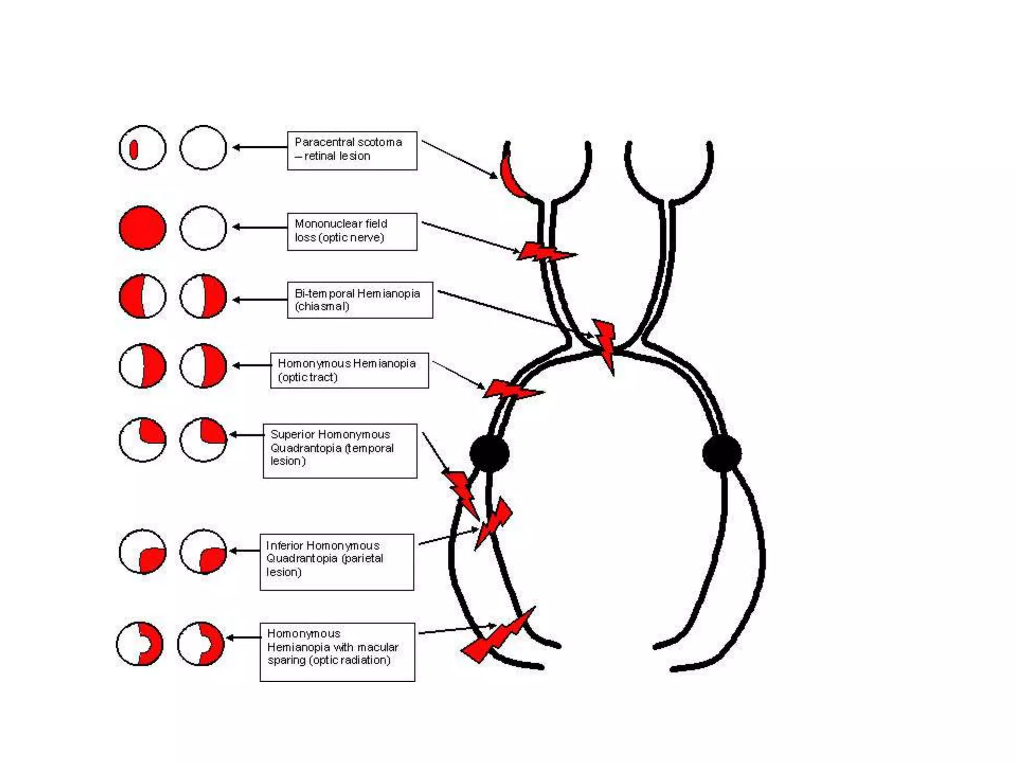 Visual pathway ,visual cortex and hemianopias | PPTX