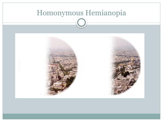 visual pathway in..... human beings.pptx