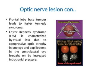 visual pathway of human anatomy for medical and par medical students | PPT