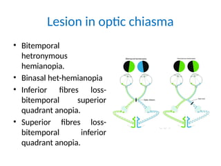 visual pathway of human anatomy for medical and par medical students | PPT