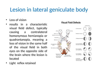 visual pathway of human anatomy for medical and par medical students | PPT
