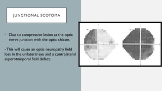 The Anatomy and the clinical side of the visual pathway | PPTX