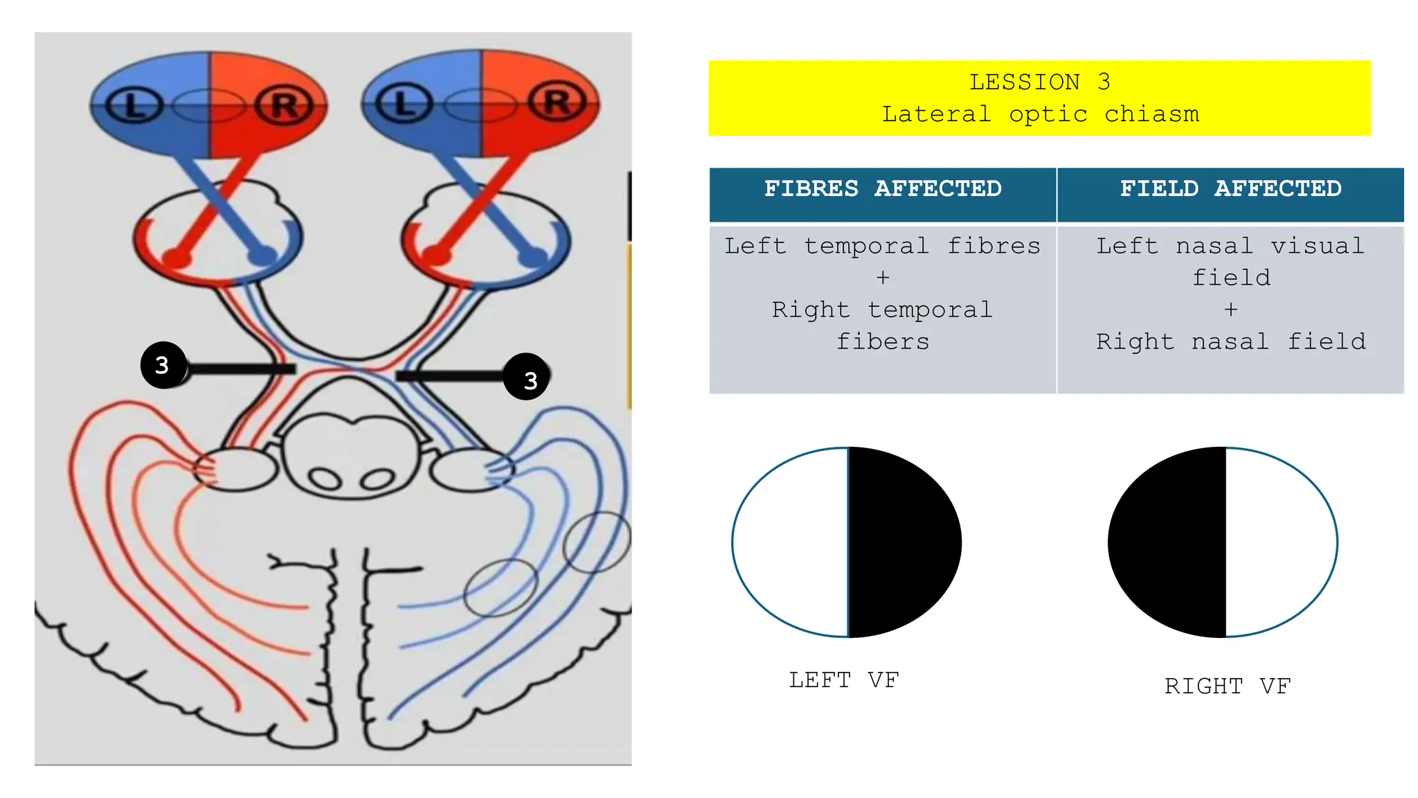 Visual pathway of eye with necessary lessions | PPTX