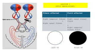 Visual pathway of eye with necessary lessions | PPTX