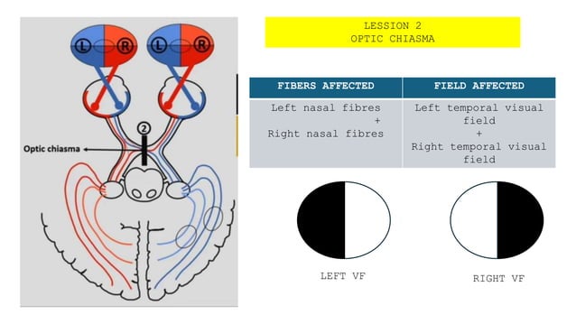 Visual pathway of eye with necessary lessions | PPT
