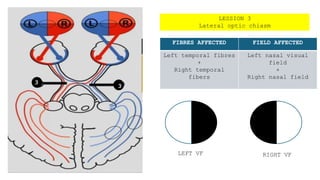 Visual pathway of eye with necessary lessions | PPTX