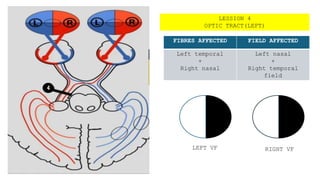 Visual pathway of eye with necessary lessions | PPTX