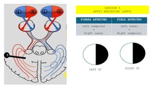 Visual pathway of eye with necessary lessions | PPTX