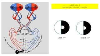 Visual pathway of eye with necessary lessions | PPTX