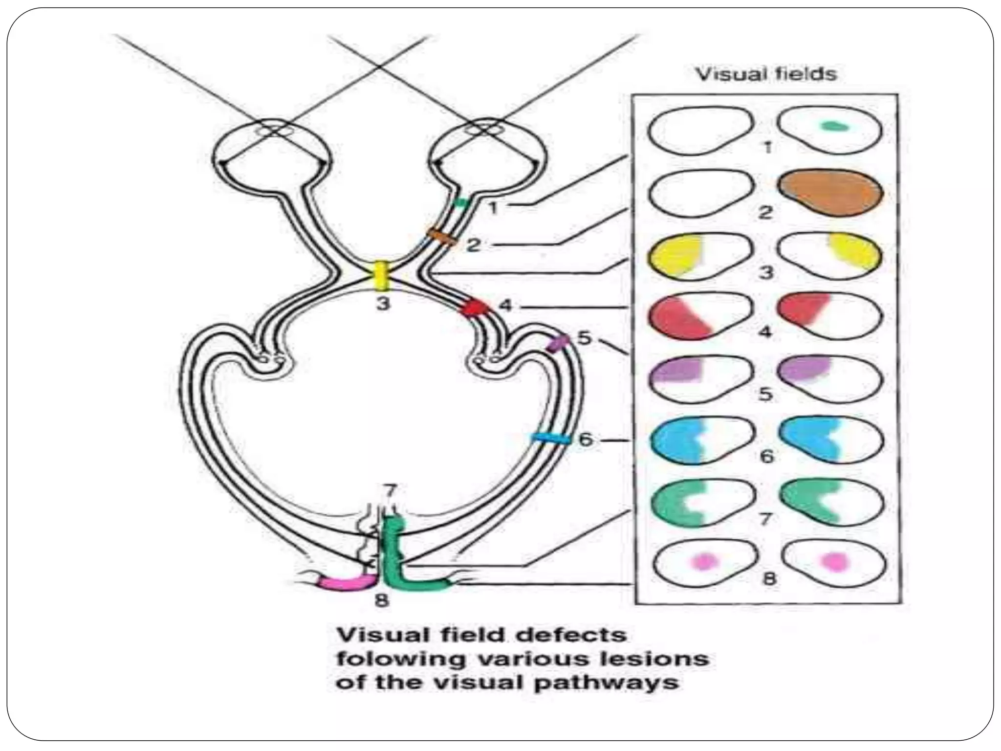 Visual pathway and its defects | PPTX