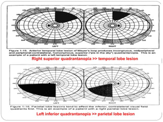 Visual pathway and its defects | PPTX