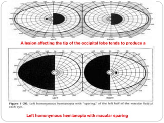 Visual pathway and its defects | PPTX
