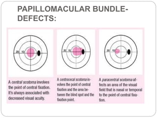Visual pathway and its defects | PPTX