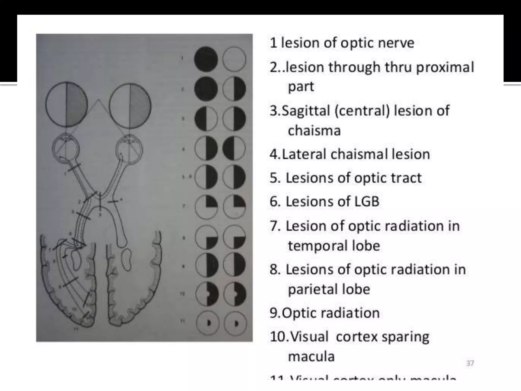 Visual pathway and its defects | PPTX
