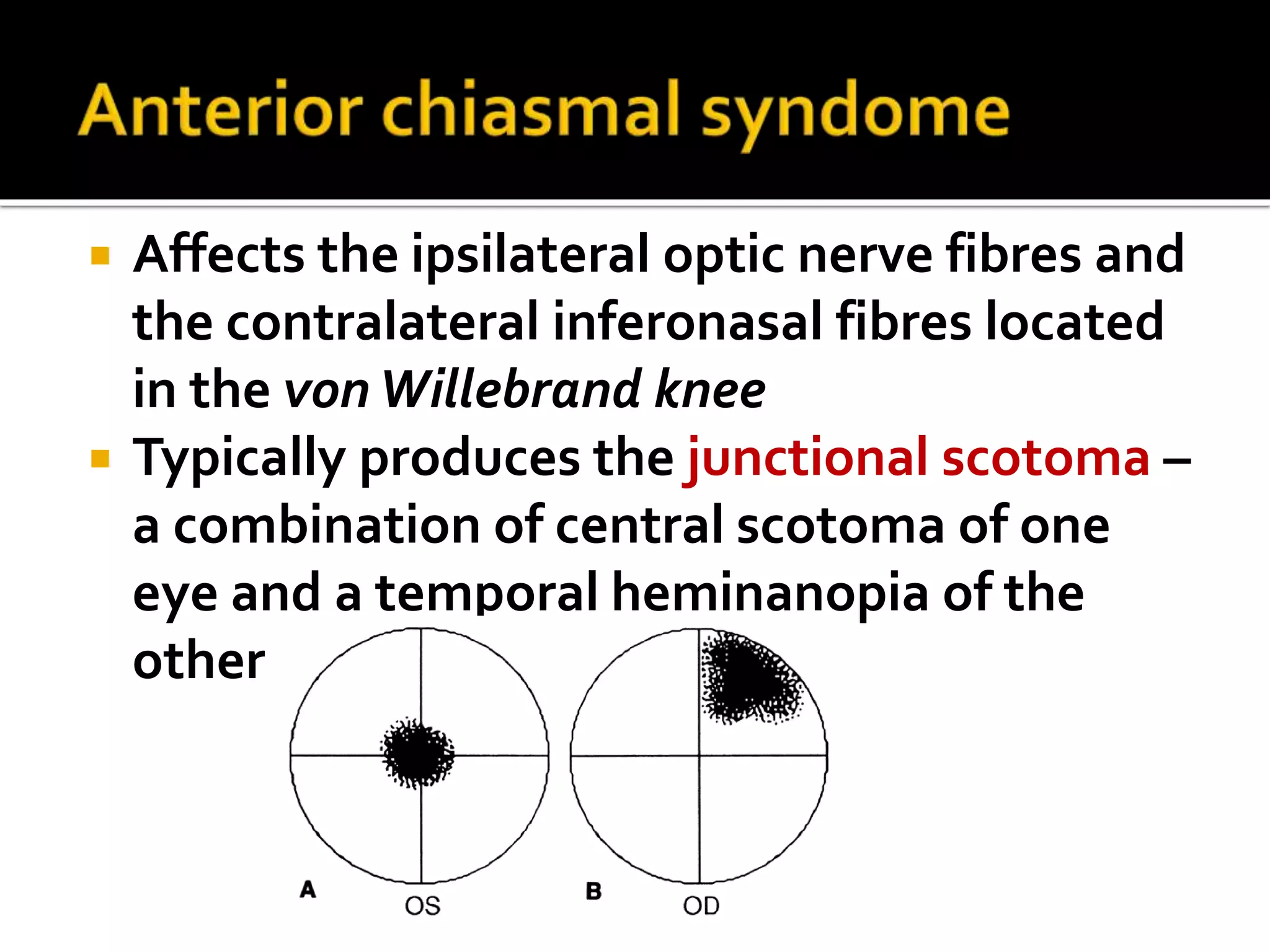 Visual pathway and its defects | PPTX